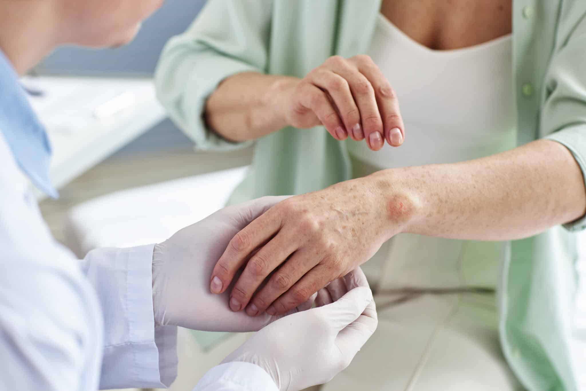 Kava Dermopathy: Causes, Symptoms and solutions - Fiji Vanua Kava